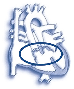 CHAPPS - Double Outlet Right Ventricle (DORV)